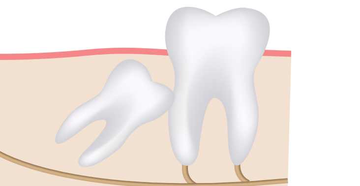 Dent incluse | Cabinet dentaire du Dr Jonathan Tourot | Paris